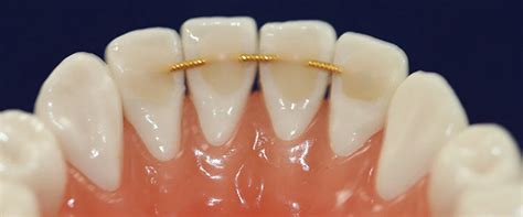Lingual Bar Vs Retainer At Andres Lowe Blog