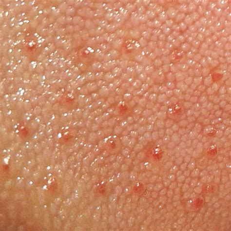 What Do Red Spots On Your Tongue Mean