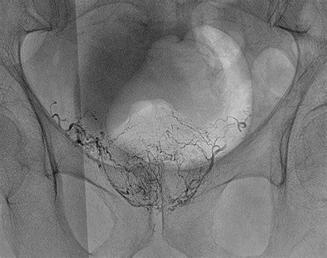 Prostate Artery Embolization For Bph Treatment From Dr Raj Ayyagari