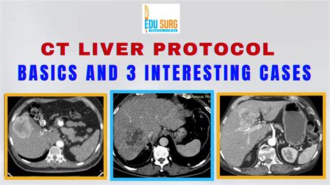 Liver Protocol Ct Scan At William Wooden Blog