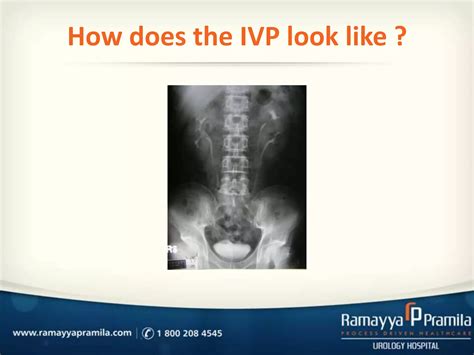 Intravenous Pyelogram Pptx