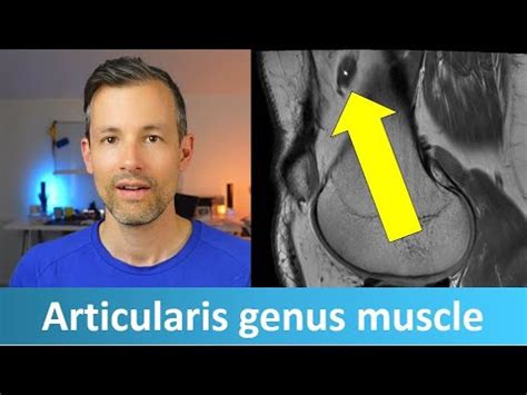 Knee Mri How To Spot Articularis Genu Muscle Youtube