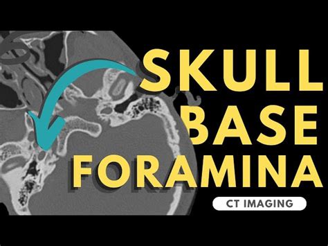 Understanding Skull Base Foramina A Comprehensive Guide To Cranial