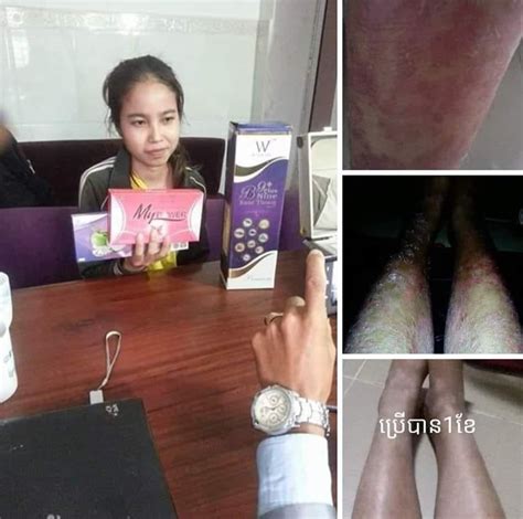 ដំណោះស្រាយ ដំណោះស្រាយអាលាក់សុីស្បែកគ្រប់ប្រភេទ 0964449789