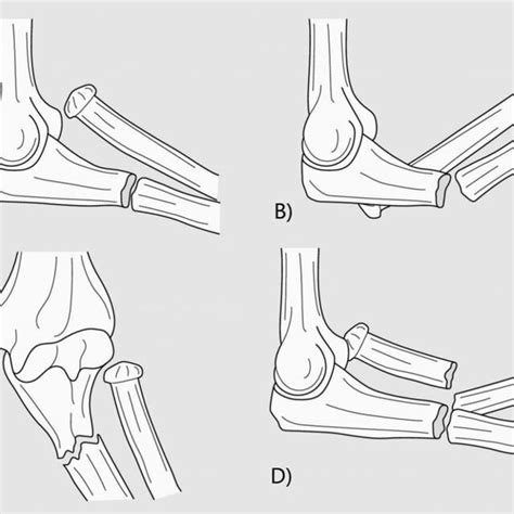 Representation Of The Bado Classification Of The Monteggia Fractures