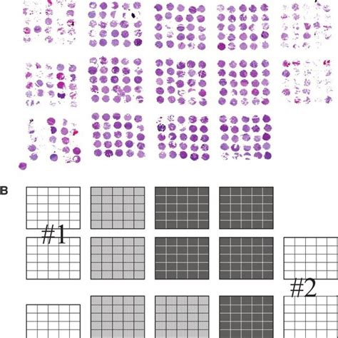 Organization Of Lung Tumor Tissue Microarray Tma A Hande Staining Of Download Scientific
