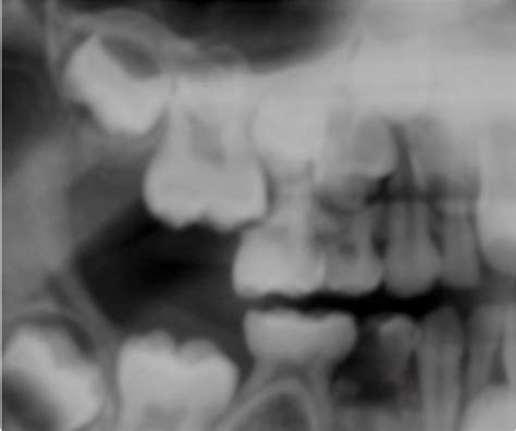 Example Of Impacted First Permanent Molar Download Scientific Diagram
