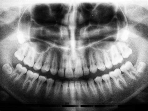 Do Wisdom Teeth Stitches Dissolve Or Fall Out Qigong Hub