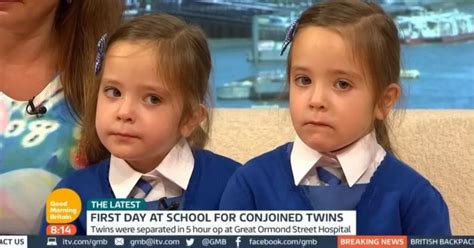 Adorable Conjoined Twins Steal Good Morning Britain Spotlight As Mother Explains They Had Hours