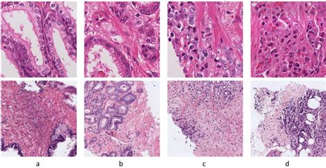 [논문 리뷰] Classification Of Gleason Grading In Prostate Cancer Histopathology Images Using Deep