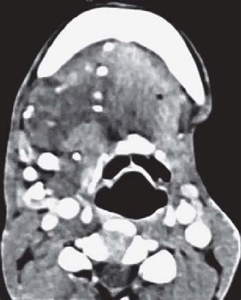 Contrast Ct Images Showing Multiple Phleboliths In Right Submandibular Download Scientific