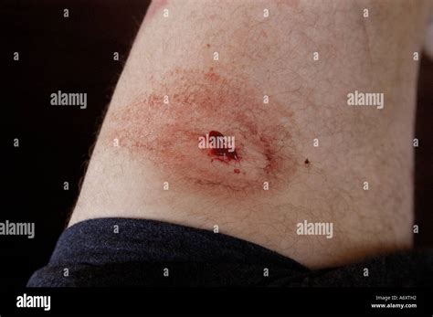 Leech Bite Bite Mark Left By A Medicinal Leech In Human Skin By