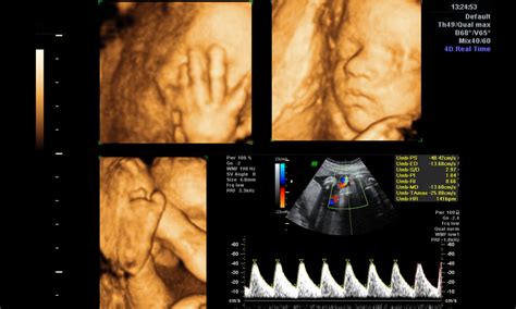 4d Ultrasound Scan Benefits Timing And What To Expect Thomson Medical