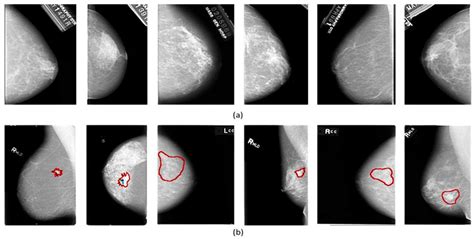 Attention Based Ensemble Network For Effective Breast Cancer