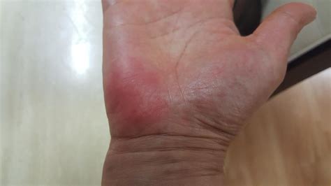 블라인드 블라블라 손바닥 통증