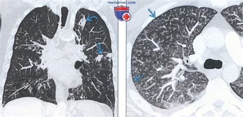 Очаги в виде дерева в почках на КТ легких причины диагностика