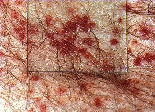 How To Check For Meningitis Meningitis Symptoms Checklist