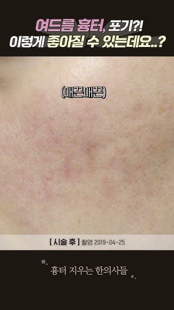 볼여드름흉터 남자여드름흉터 여드름흉터새살침 여드름흉터치료 여드름패인흉터 패인흉터치료 로담한의원 새살침코라테라피 코라테라피 여드름흉터코라테라피 Shorts