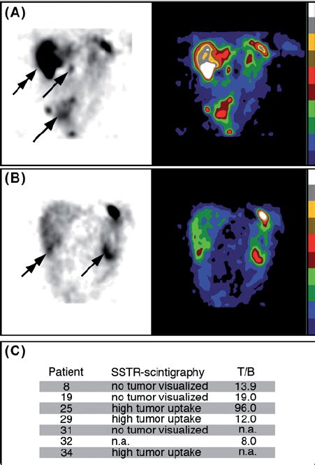 Gist In Primary Culture Tumor Cells Were Positive For The Gist Markers