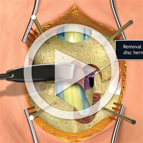 Thoracic Decompression And Fusion Trialexhibits Inc