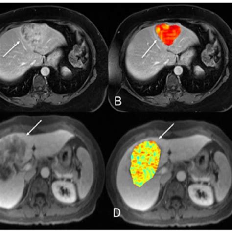 Mri Texture Feature Of Difference Entropy Found To Be A Significant
