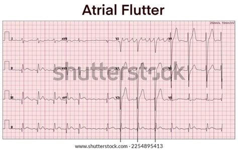 Electrocardiogram Show Atrial Flutter Pattern Afl Stock Illustration 2254895413 Shutterstock