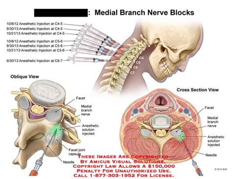 Medial Branch Nerve Blocks