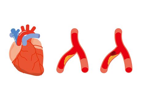 心疾患種類 心臓の病気 一覧表 Vishuji