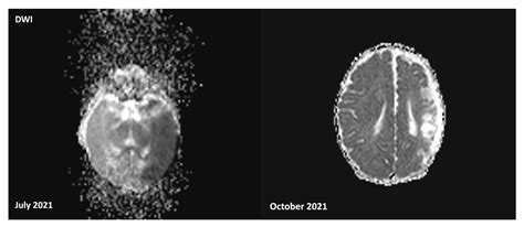Exploring The Role Of Irf6 In Perinatal Arterial Ischemic Stroke A Case Of A Newborn With