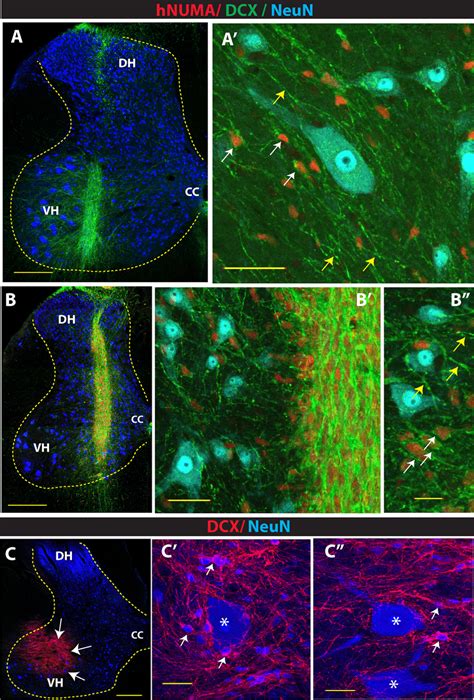 Dcx Expression In Spinally Grafted Human Es Derived And Porcine