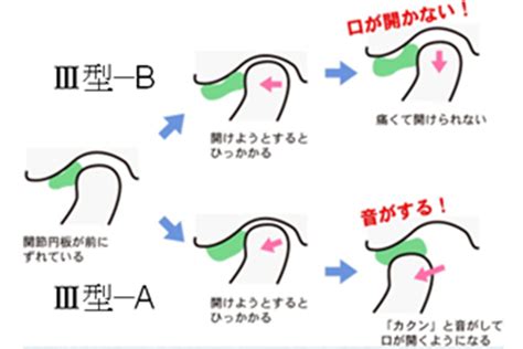 顎関節症の4つのタイプ 赤坂の歯医者赤坂デンタルオフィス土日診療