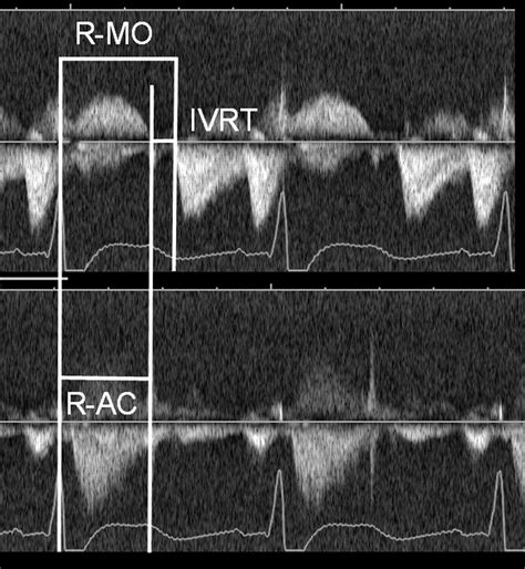 Effects Of Levosimendan On Left Ventricular Relaxation And Early