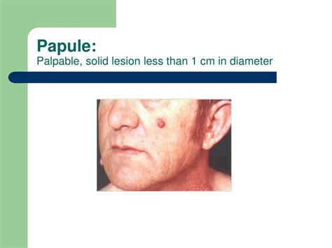 Ppt The Fundamentals Of Dermatologic Diagnosis Powerpoint