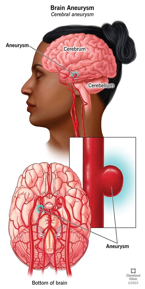 Intracranial Aneurysm Nonruptured Cerebral Aneurysm What You Need To