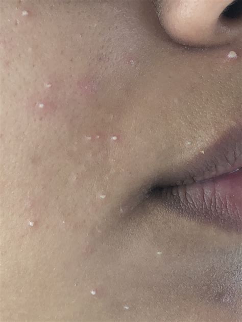 Can Anyone Explain What This Is Cluster Of Small White Bumps Acne Forum