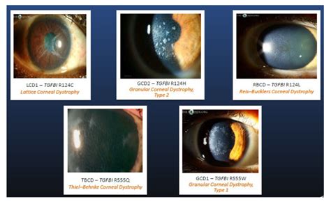 Corneal Dystrophy