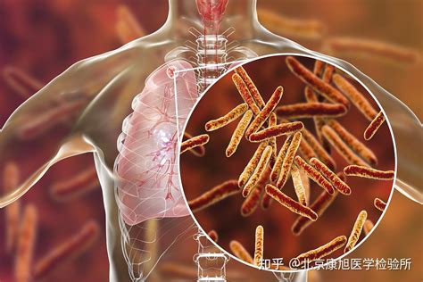 【感染专题】结核病——结核分枝杆菌 知乎
