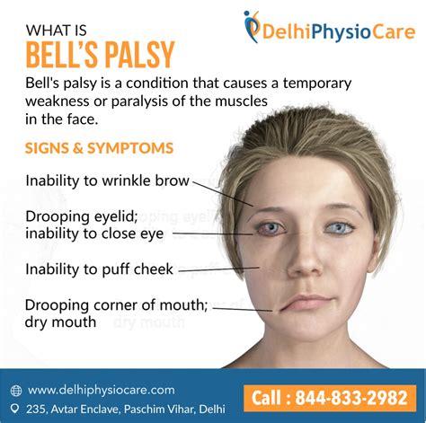 Dr Shruti Physiotherapy Clinic Bells Palsy Also Called Idiopathic