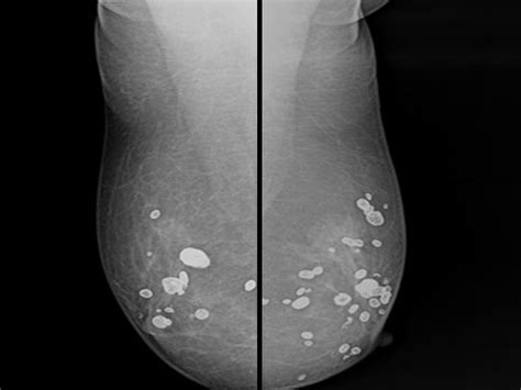 Atlas Of Breast Cancer Early Detection