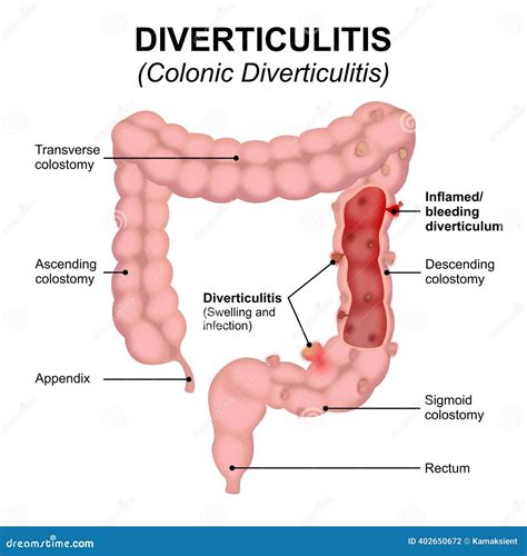 Diverticulitis Colonic Diverticulitis Flashcard Illustration Stock