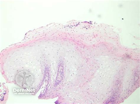 Hairy Leukoplakia Histology Oral Proliferative Verrucous Leukoplakia