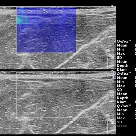 Shear Wave Elastography Of The Breast Skin Of A 49 Year Old Female Download Scientific Diagram