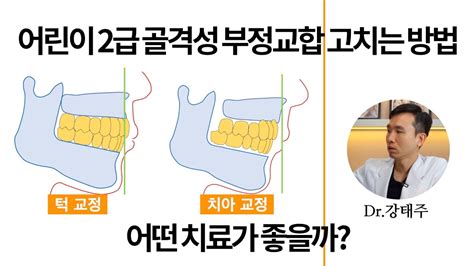 성장기 2급 부정교합 교정 치료 헤드기어 알려드립니다 Youtube