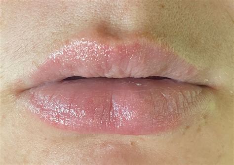 Allergic Reaction On Lips From Chapstick
