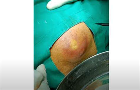 Large Massive Abscess On Back Drainage New Pimple Popping Videos