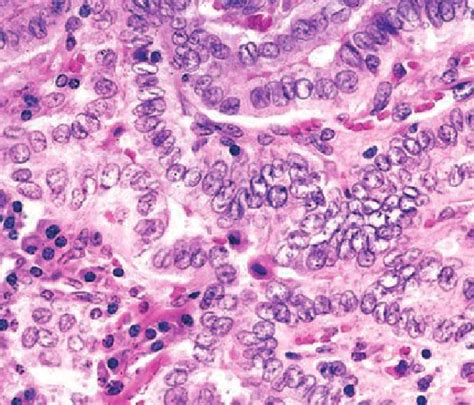 Figura 2 Ematossilina Eosina Caratteristiche Inclusioni Nucleari A