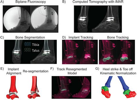 A Biplane Fluoroscopy Data Were Collected In 2 Calibrated Views Download Scientific Diagram