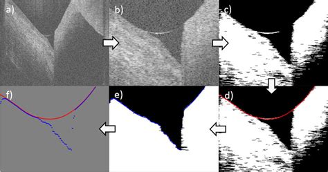 step by step illustration of the tear meniscus segmentation algorithm