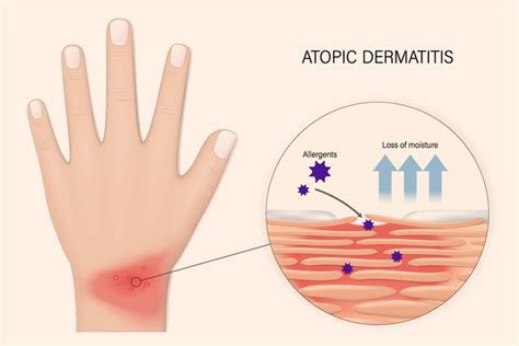Atopic Dermatitis Vs Contact Dermatitis Expert Explains How To