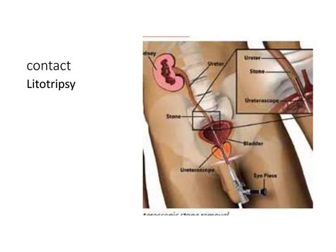 Obstructive Uropathy 1 Pptx Medical Health